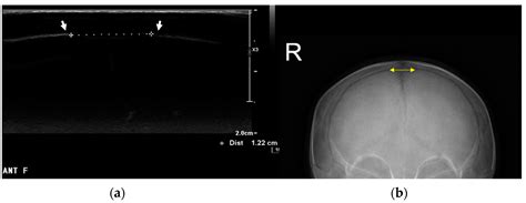 Ultrasonographic Measurement Of Anterior Fontanelle Size In Infants With Deformational Plagiocephaly