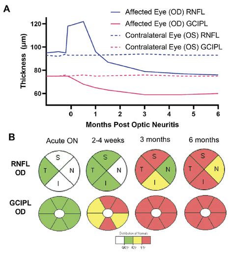 Ms Minute Retinal Optical Coherence Tomography For Ms