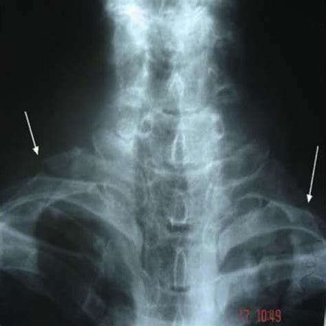 Pdf Isolated Bilateral First Rib Fracture Associated With Congenital Cervical Block Vertebra