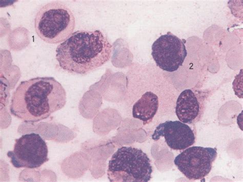 急性粒细胞白血病部分分化型 M2b型 实验诊断学 医学