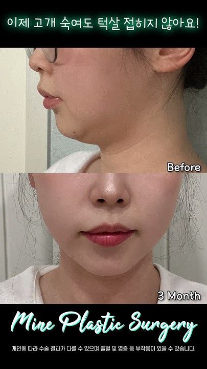 고개 숙여도 턱살이 안접혀요이중턱 이중턱근육묶기 Shorts Youtube