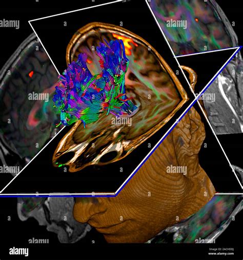 Brain Tumour Coloured 3d Diffusion Tensor Imaging Dti And Magnetic
