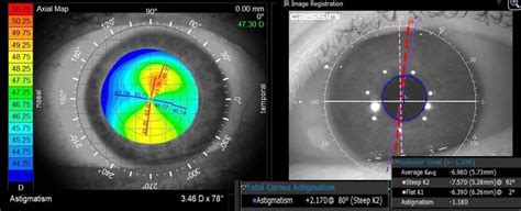 7 Steps To Toric Iol Success