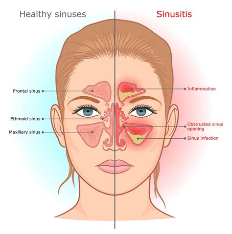 The Common Cold Vs Sinus Infections How To Tell The Difference Annapolis And Severna Park Md