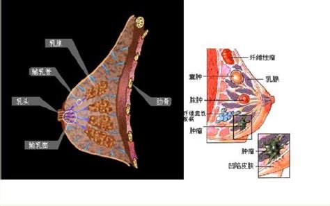 乳腺增生图册 360百科