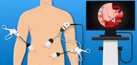 Laparoscopic Colon Surgery In Pune And Mumabi Minimally Invasive