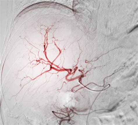 550 Hepatic Artery Stockfoto S Afbeeldingen En Royalty Free Beelden