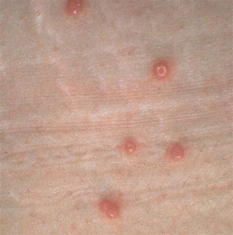 What Does Lymphoma Look Like On Skin Printable Online