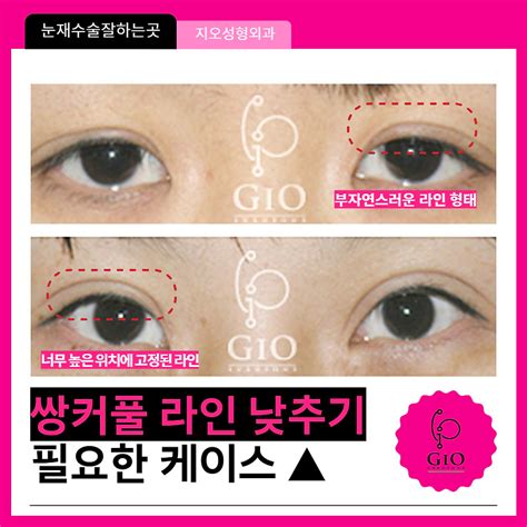 쌍커풀 라인 낮추기 쌍수 두줄 따기 절제 방법 중 뭘해야할까