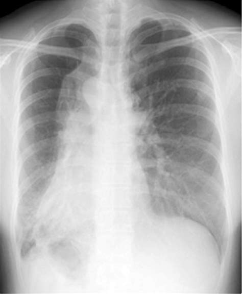 Chest X Ray Examination Performed On Admission Chest X Ray Image Download Scientific Diagram