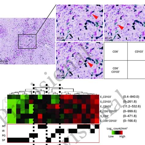 Association Of Histopathological Subtypes Of High Grade Serous Ovarian
