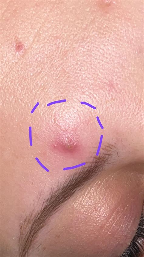 Mrsa Or Angry Pimple Rdiagnoseme