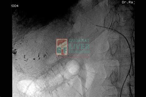 Gujarat Gastro And Liver Foundation Transarterial Chemoembolization