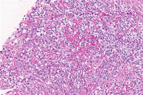 50 Facts About Igg4 Related Disease