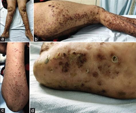 Rheumatoid Neutrophilic Dermatosis The Distinct Entity With Florid