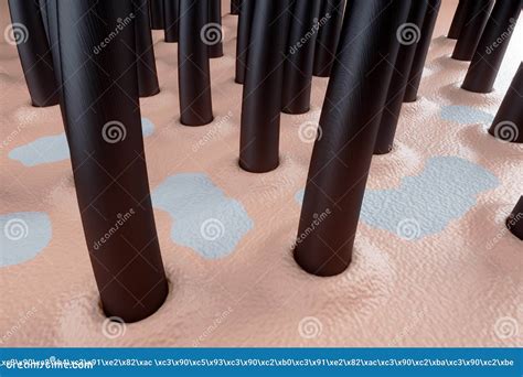 Fungal Disease Of The Skin Dandruff On The Scalp An Enlarged Image Of The Hair And Scalp