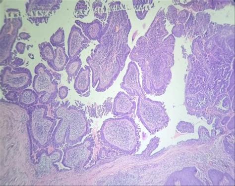 Three Linearly Arranged Erythematous Nodules Covered With Crusting