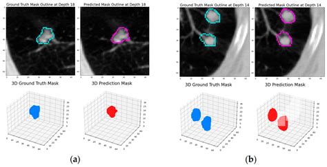 Dynamic Patch Based Sample Generation For Pulmonary Nodule Segmentation In Low Dose Ct Scans