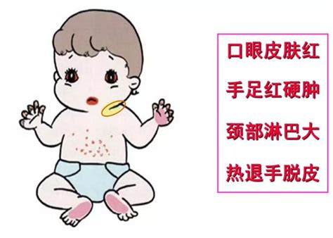 宝宝得了川崎病怎么办？我们继续说说还不被熟知的川崎病（下）