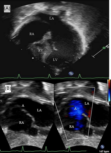Neonate With Pulmonary Atresia Intact Ventricular Septum With Download Scientific Diagram
