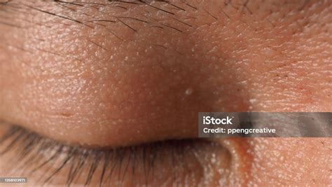 얼굴에 사마귀 눈 근처 사마귀의 매크로 샷 눈 코와 목 주위 피부에 유두종 모반 유두또는 두더지의 피부를 닫습니다 작은 하드