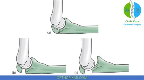 Olecranon Fracture Classification Olecranon Fracture Classification