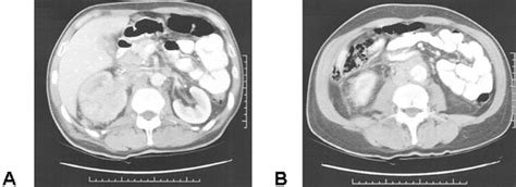 Differential Diagnosis Of Hypercalcemia In Renal Malignancy Urology