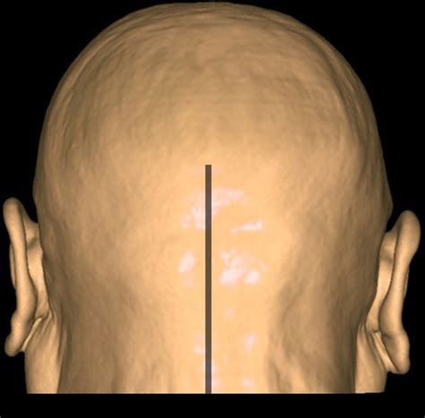 Decompressive Hemicraniectomy Peripheral Brain