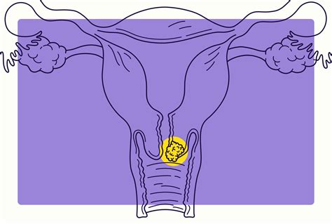 Cervical Cancer Types Symptoms Causes Diagnosis Treatment And More