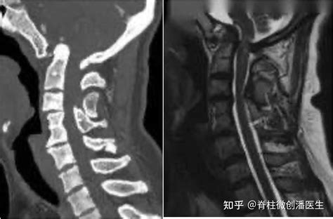 颅底凹陷症 知乎