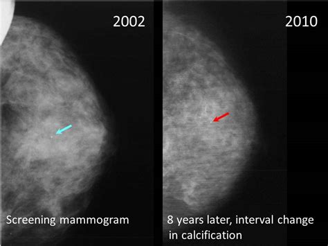 Atlas Of Breast Cancer Early Detection