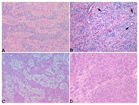 Uterine Tumor Resembling Ovarian Sex Cord Tumor Utrosct A Rare