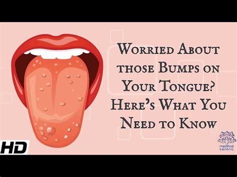 Bumps On The Tongue Transient Lingual Papillitis Facty Health