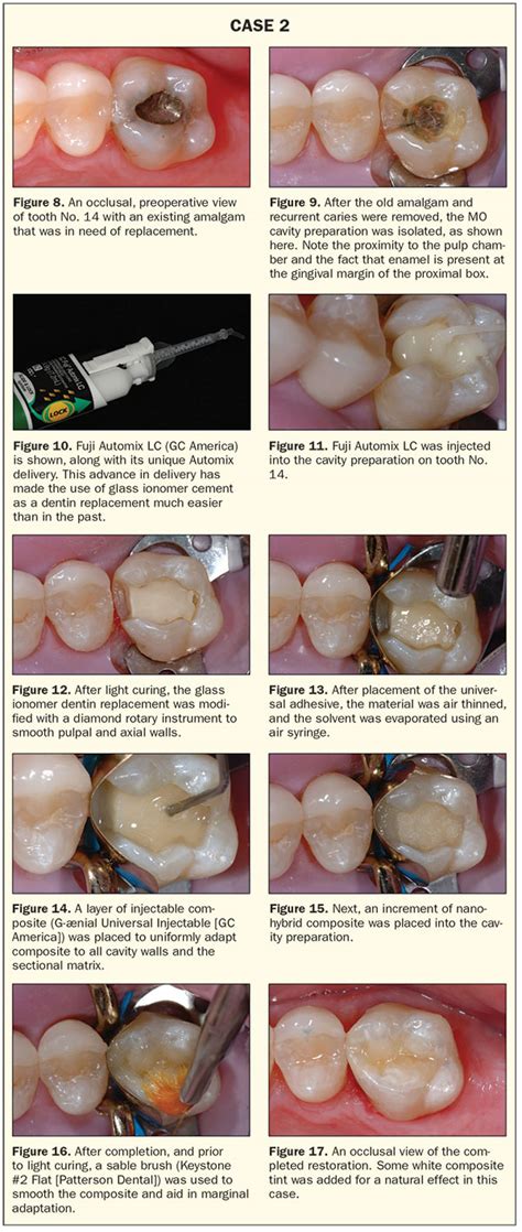 Material Options For Class Ii Composite Restorations Varied Clinical