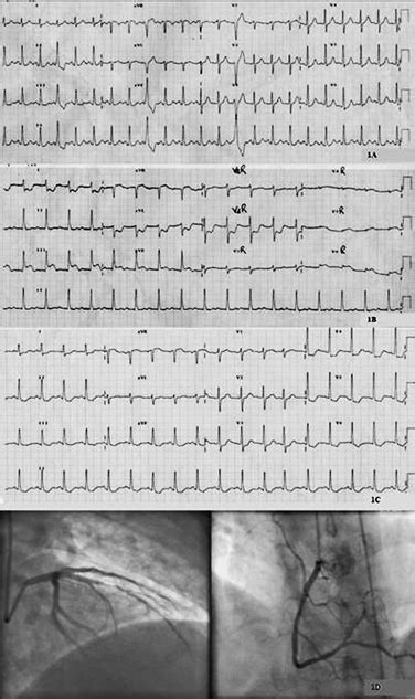 A Sinus Tachycardia Interrupted By Ventricular Ectopy B