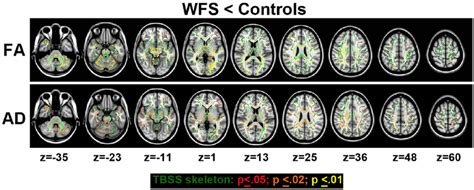Results From Tract Based Spatial Statistics Tbss Analysis Fractional