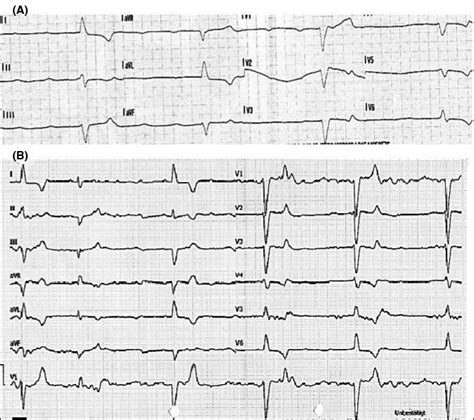 Hyperkalemia A Persisting Risk A Case Report And Update On Current Management Pmc
