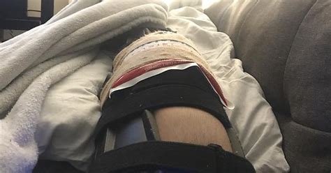 Acl Reconstruction And Miniscus Repair This Is My Life Now Album