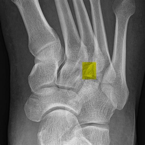 Metatarsal Head Fracture