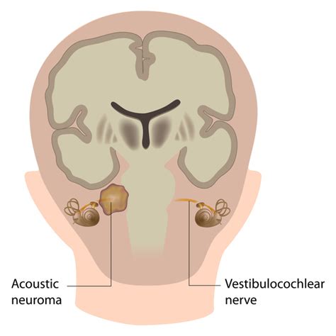 Neurofibromatosis Type 2 Medlineplus Genetics