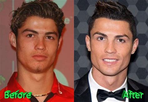 Ronaldo Before And After Veneers At Shirley Herrmann Blog
