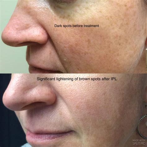 Effective Acne Hyperpigmentation Treatment For Clear Skin Vivaa