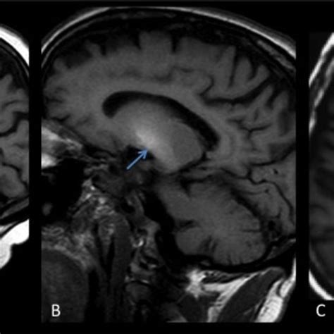 A Axial Non Contrast Ct Demonstrates Interval Hyperdensity Within The Download Scientific