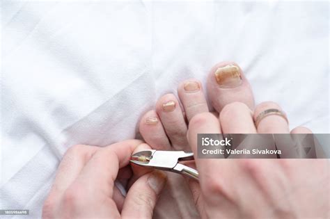 손톱 균류로 손톱을 자른 남성 손 다리에 곰팡이 감염 손발톱 진균증이있는 손가락 관리 및 치료 곰팡이 때문에 손톱이 손상된 발 클로즈업 건강관리와 의술에 대한 스톡 사진 및