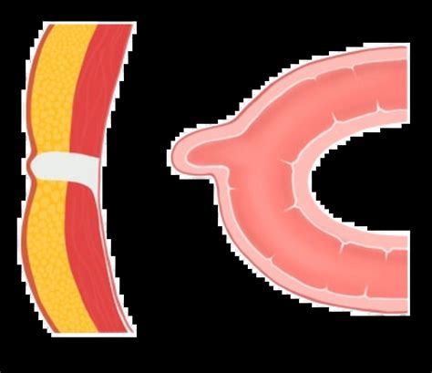 Meckels Diverticulum Dr Kumargurubaran