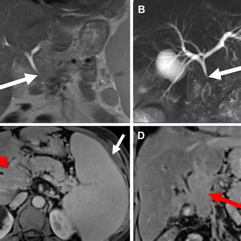 Ischemic Cholangiopathy In A Patient With Orthotopic Liver