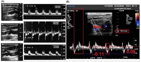 Velocity Reversal And Flow Reversal A Lower And Upper Normal