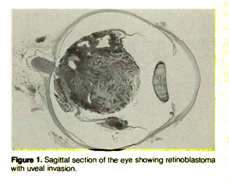 Retinoblastoma Drawing