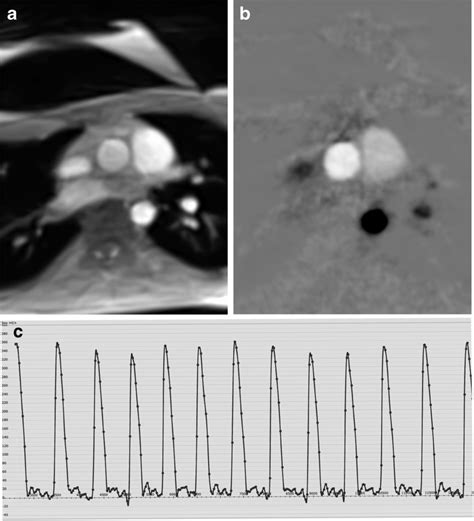 Real Time Phase Contrast Flow Mri Of The Ascending Aorta In A Download Scientific Diagram