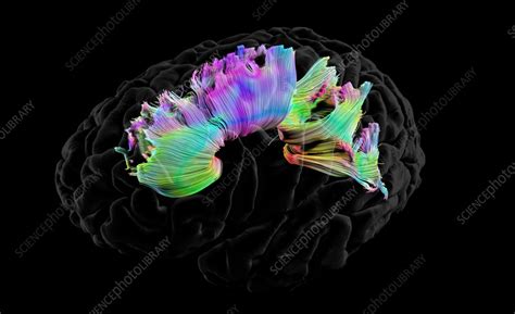 Corpus Callosum DTI MRI Scan Stock Image C Science Photo Library